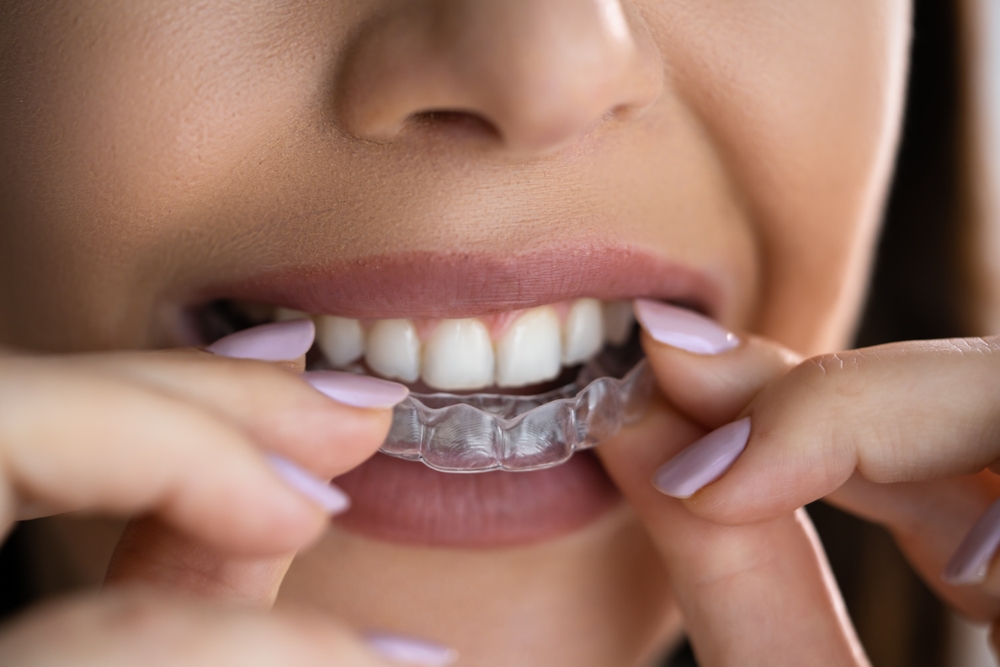 Oral Appliances - The Cincinnati Dental Group